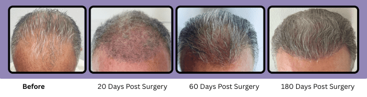 FUE Hair Transplant in Littleton, Louisville & Las Vegas | Beyond Stem ...